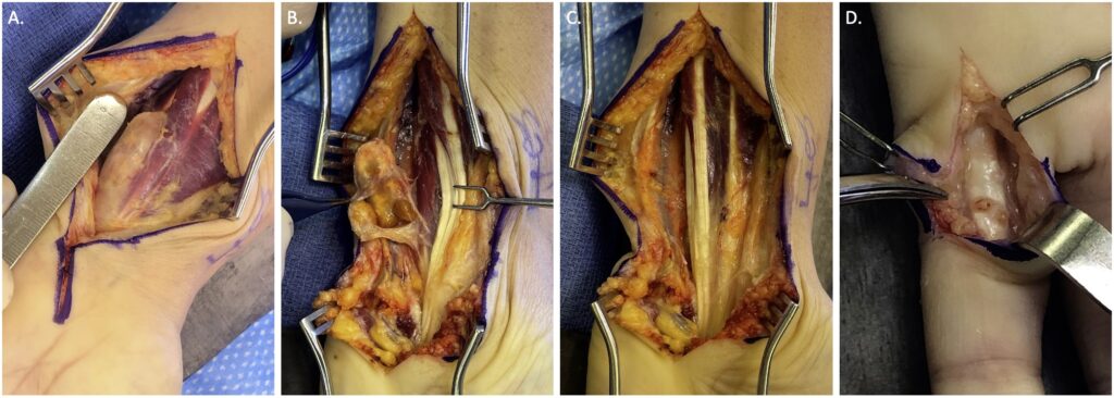 Recurrent Multifocal Giant Cell Tumor of Tendon Sheath of the 5th ...