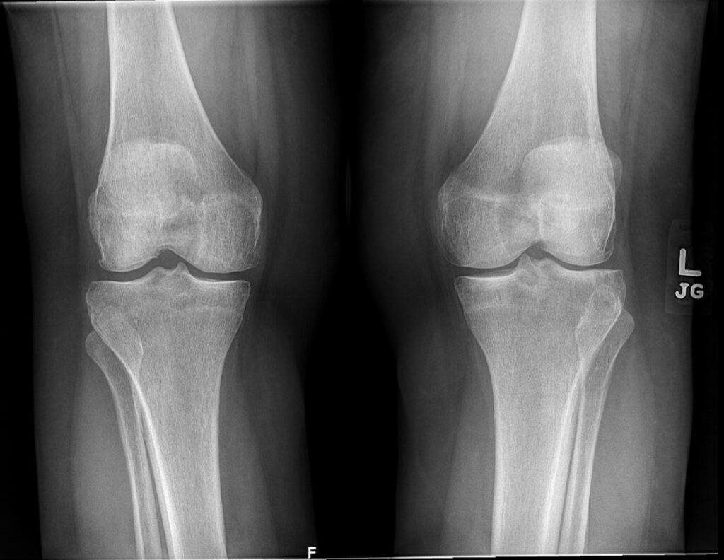 Superior Patellar Dislocation: Case Report and Comprehensive Literature ...