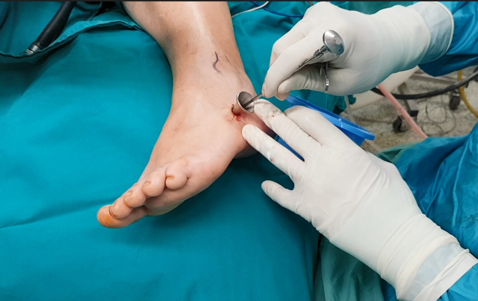 Management of Calcaneal Cysts with Endoscopic Techniques: a Systematic ...