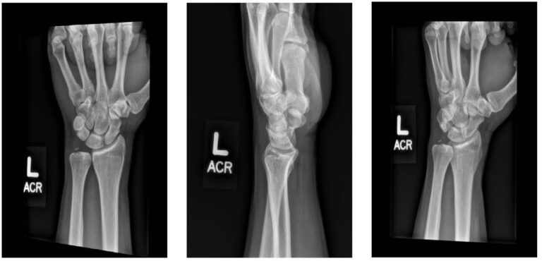 Long-Term Follow-Up After Posterior Interosseous Neurectomy in a ...