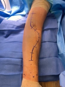Upper Extremity Compartment Syndrome in a 48-year-old Male on ...
